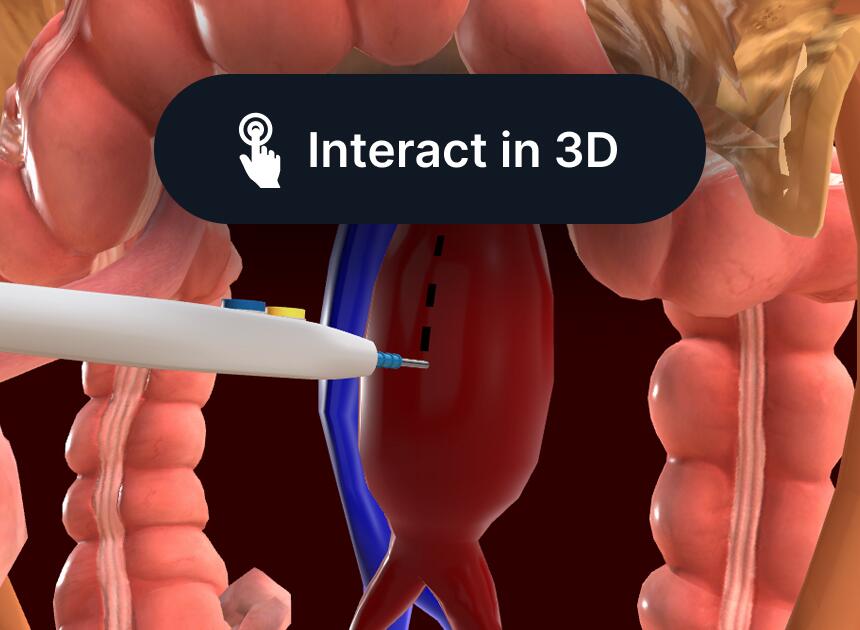 Aortobifemoral Bypass By Sagar S Gandhi MD J J MedTech aortobifemoral-bypass-by-sagar-s-gandhi-md-j-j-medtech